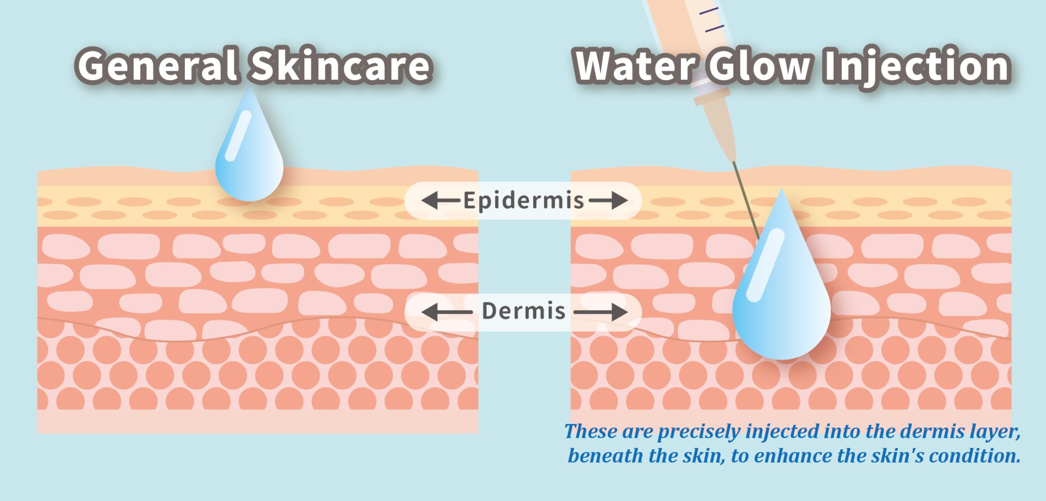 Water Glow Injection/Manual Water Glow Injection-improving skin quality ...