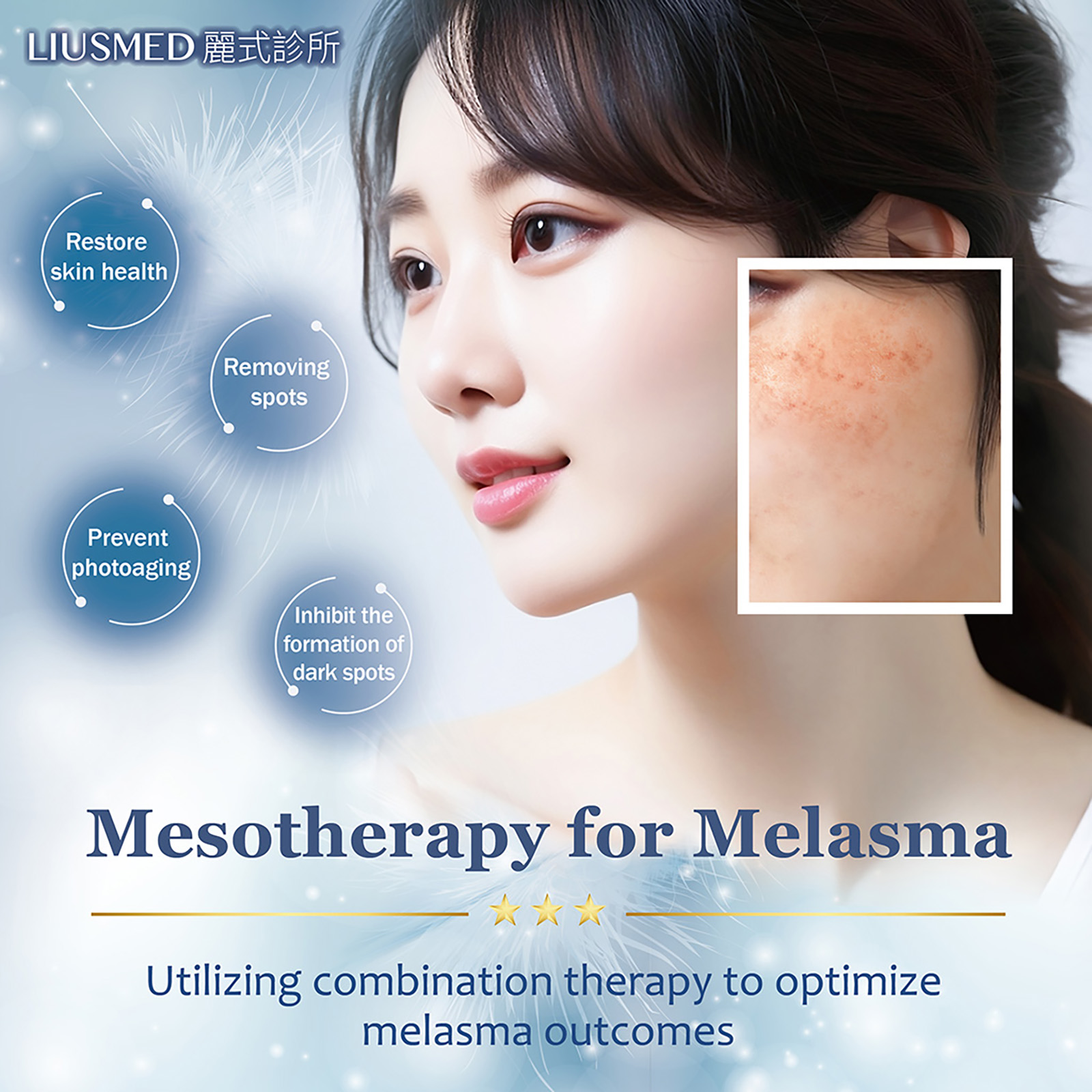 Mesotherapy for Melasma: The Revolutionary Combination Therapy for ...