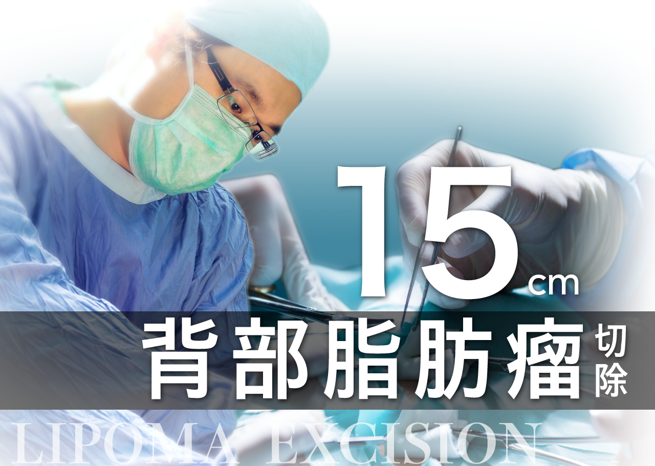 Removal of 15 cm Back Lipoma | Lipoma Surgery Record. Lipoma and ...