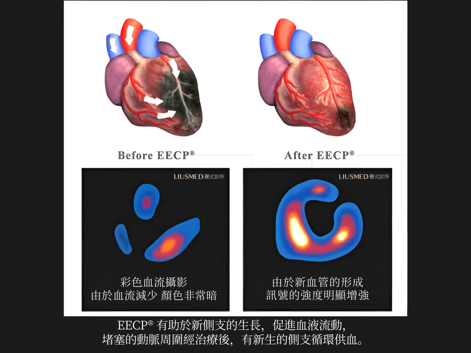 EECP體外反搏是什麼？一篇搞懂EECP功效、應用範圍與心血管/神經/多重健康效益 - 劉達儒醫師